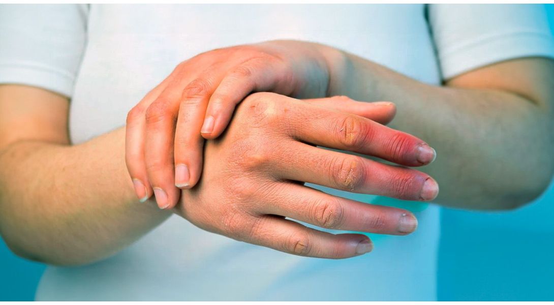 Crema para Sabañones